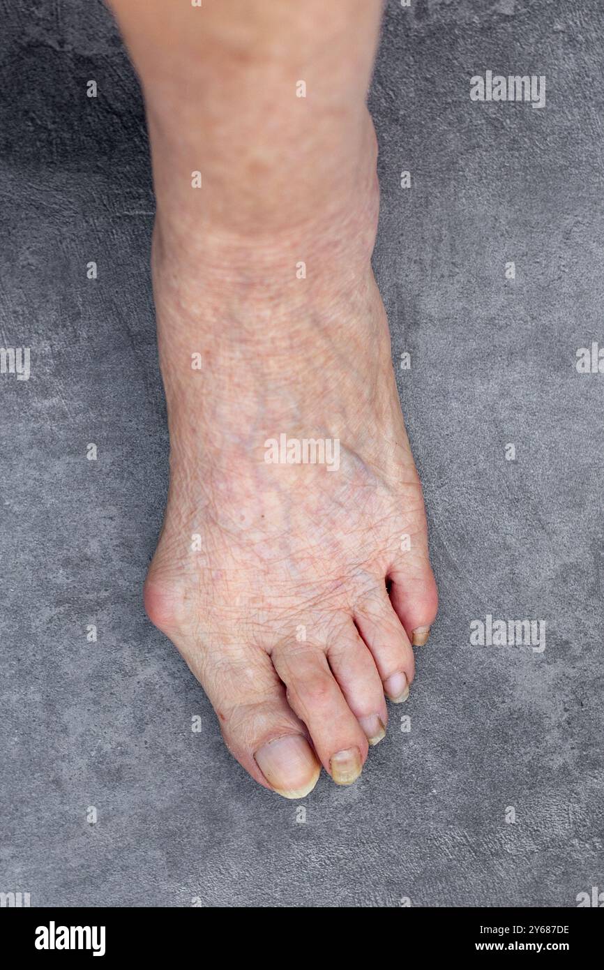 An old woman's foot with untrimmed nails and a painful, enlarged big ...