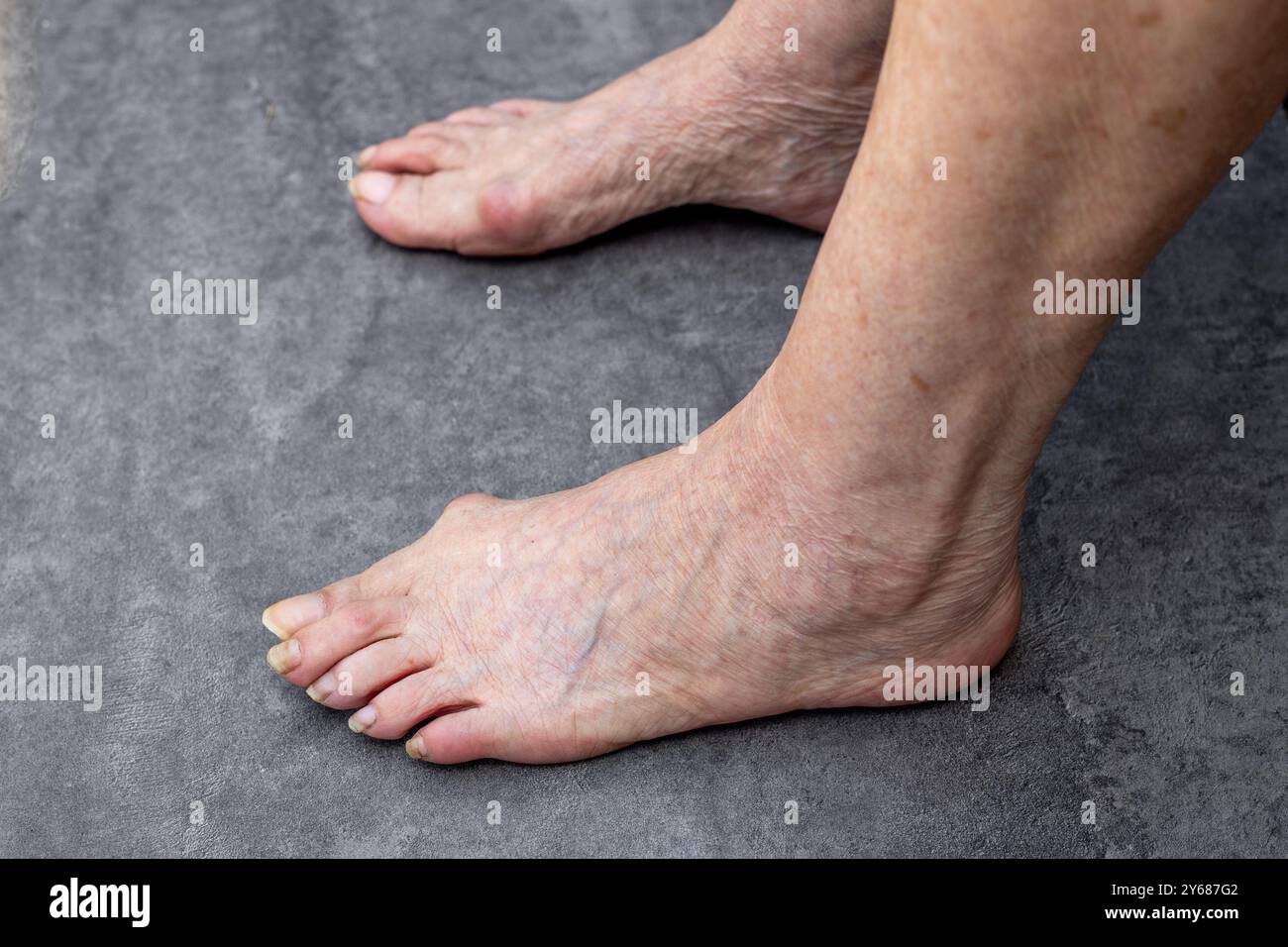 Old woman's feet with untrimmed nails and a painful, enlarged big toe ...