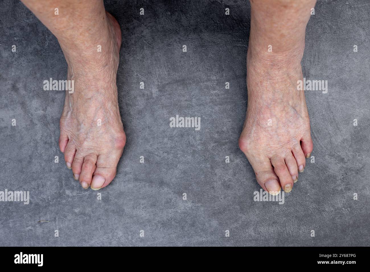 An old woman's feet with untrimmed nails and a painful, enlarged bunion ...