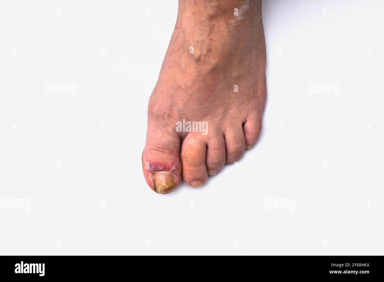 nail infection. toenail fungus lesion Stock Photo - Alamy