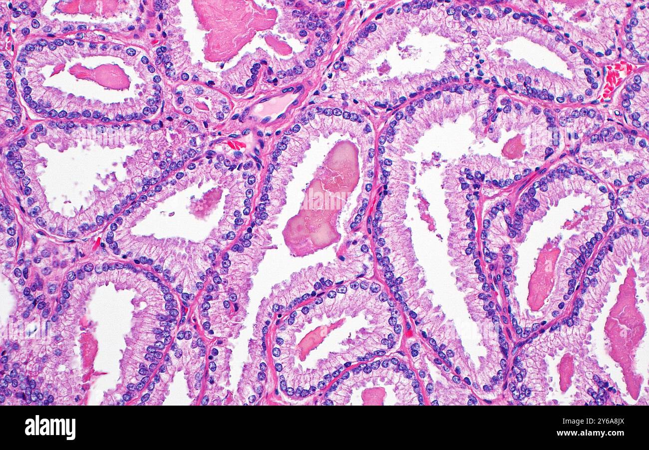 Light micrograph of prostate cancer glands. The cancer glands cells are ...
