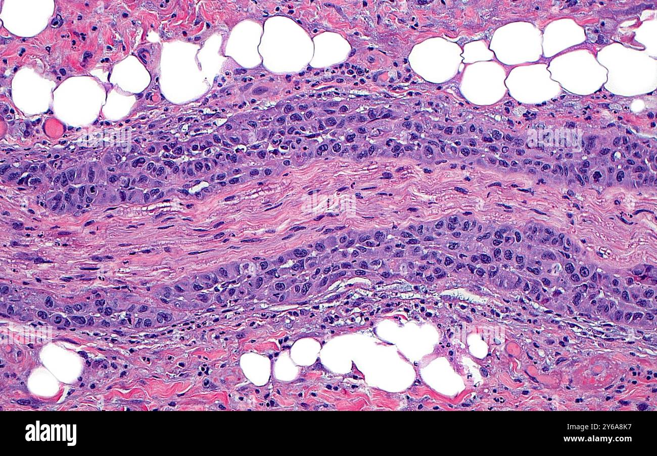 Light micrograph of perineural invasion. Perineural invasion occurs ...