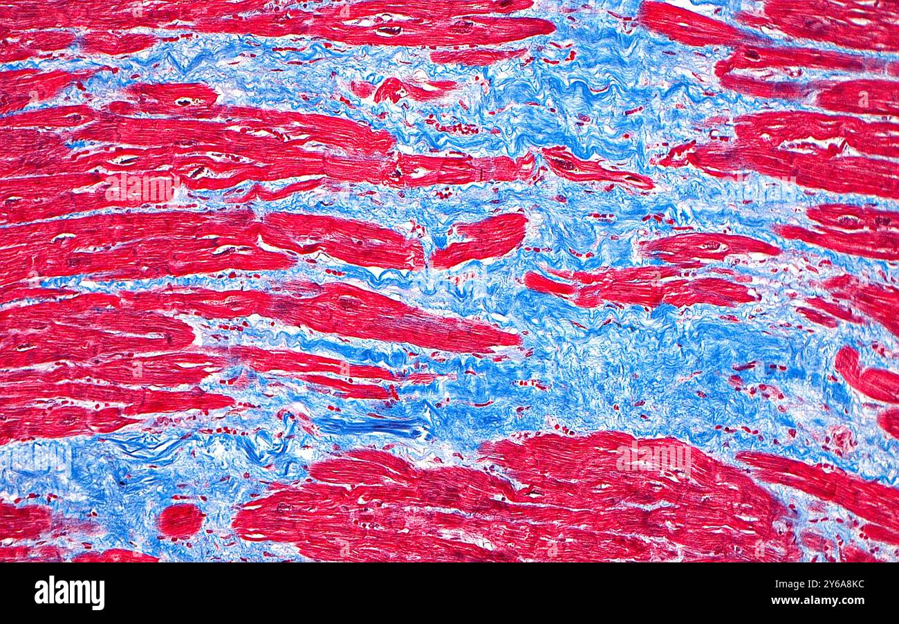Light micrograph of myocardial (heart muscle) fibrosis. Fibrosis occurs ...
