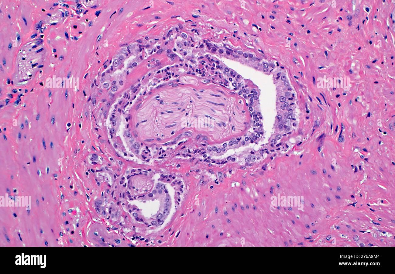 Light micrograph of perineural invasion by prostate cancer. Perineural ...
