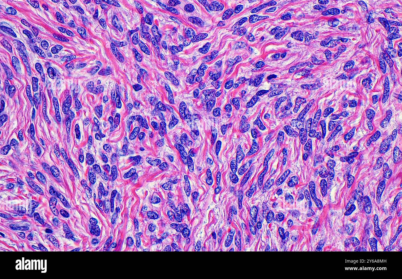 Light micrograph of cells of a benign prostatic stromal nodule. The ...