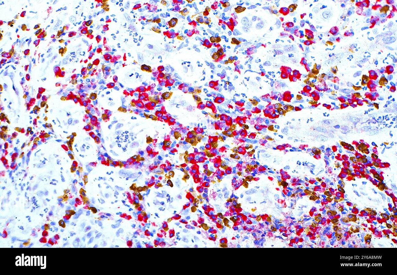 Light micrograph of polytypic plasma cells. This stain for Kappa and ...