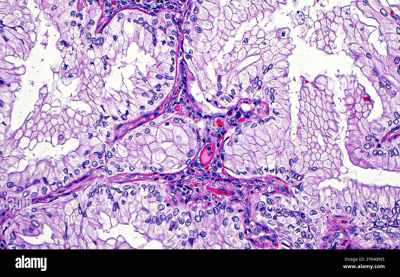 Light micrograph of mucinous lung adenocarcinoma. This type of lung ...