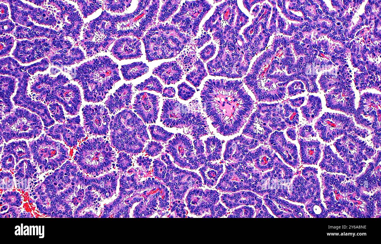 Light micrograph of prostatic ductal adenocarcinoma. This type of ...