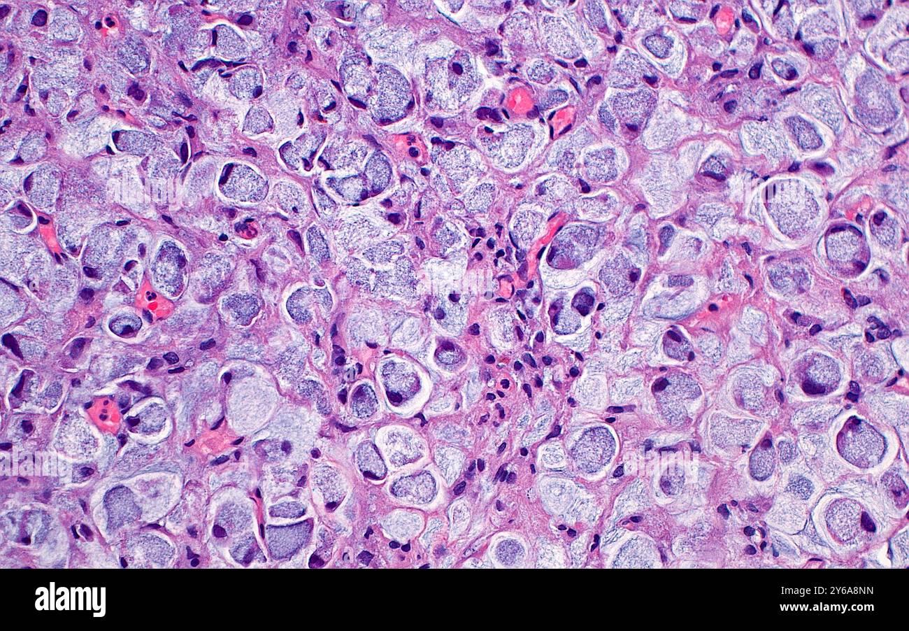 Light micrograph of signet ring cell carcinoma. Signet ring cell ...