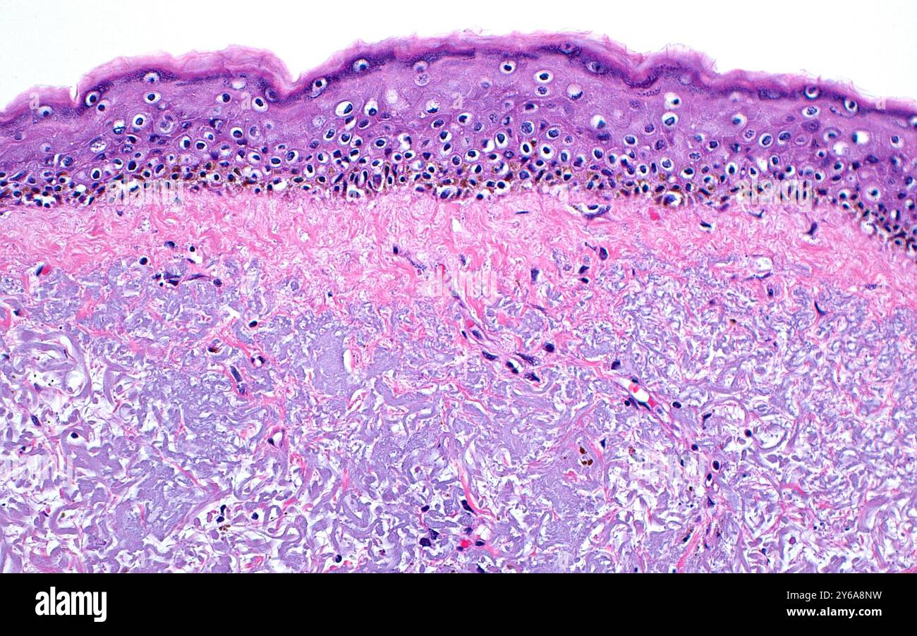 Light micrograph of solar elastosis. Solar elastosis is a reaction of ...