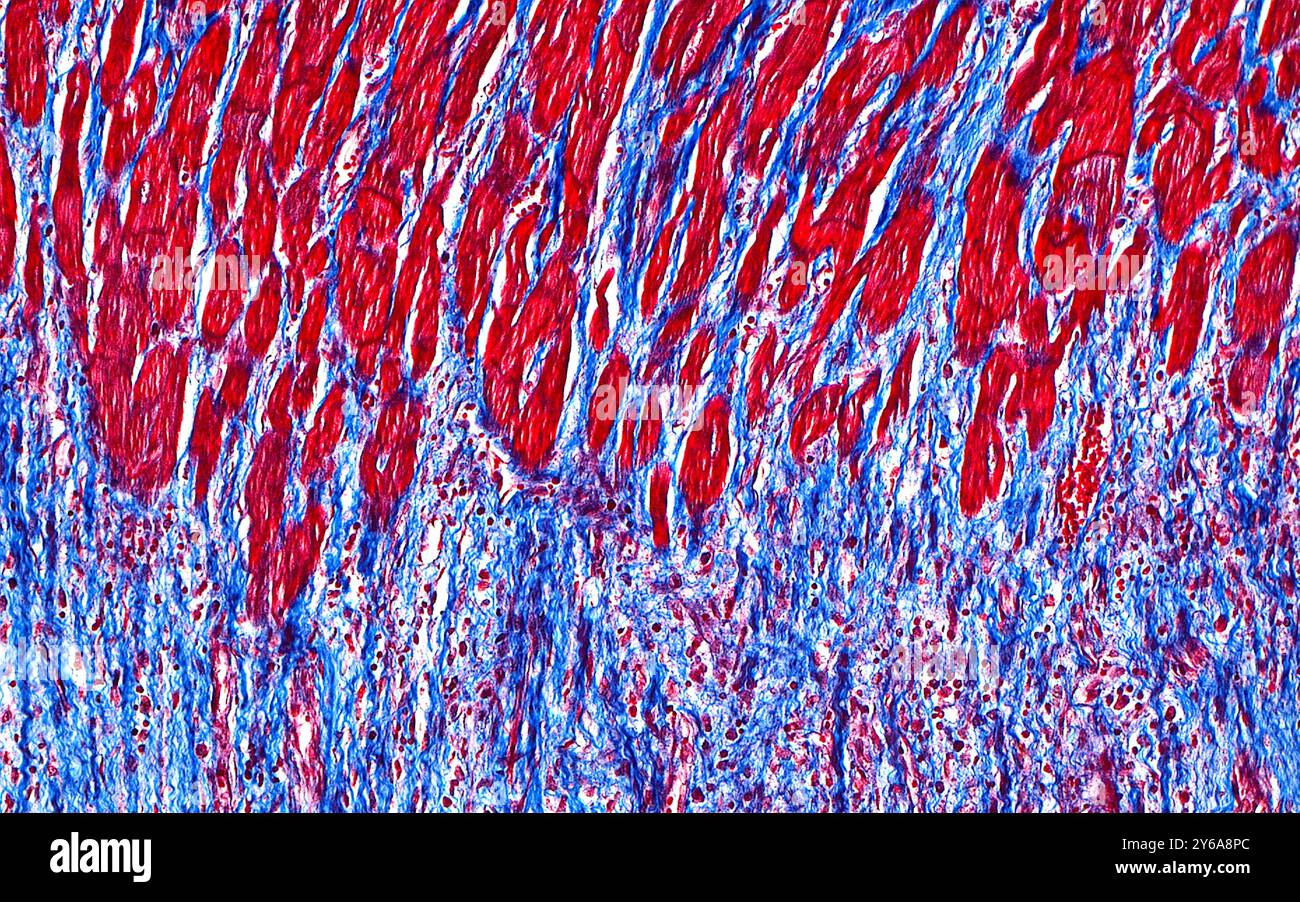 Light micrograph of myocardial (heart muscle) fibrosis. Fibrosis occurs ...