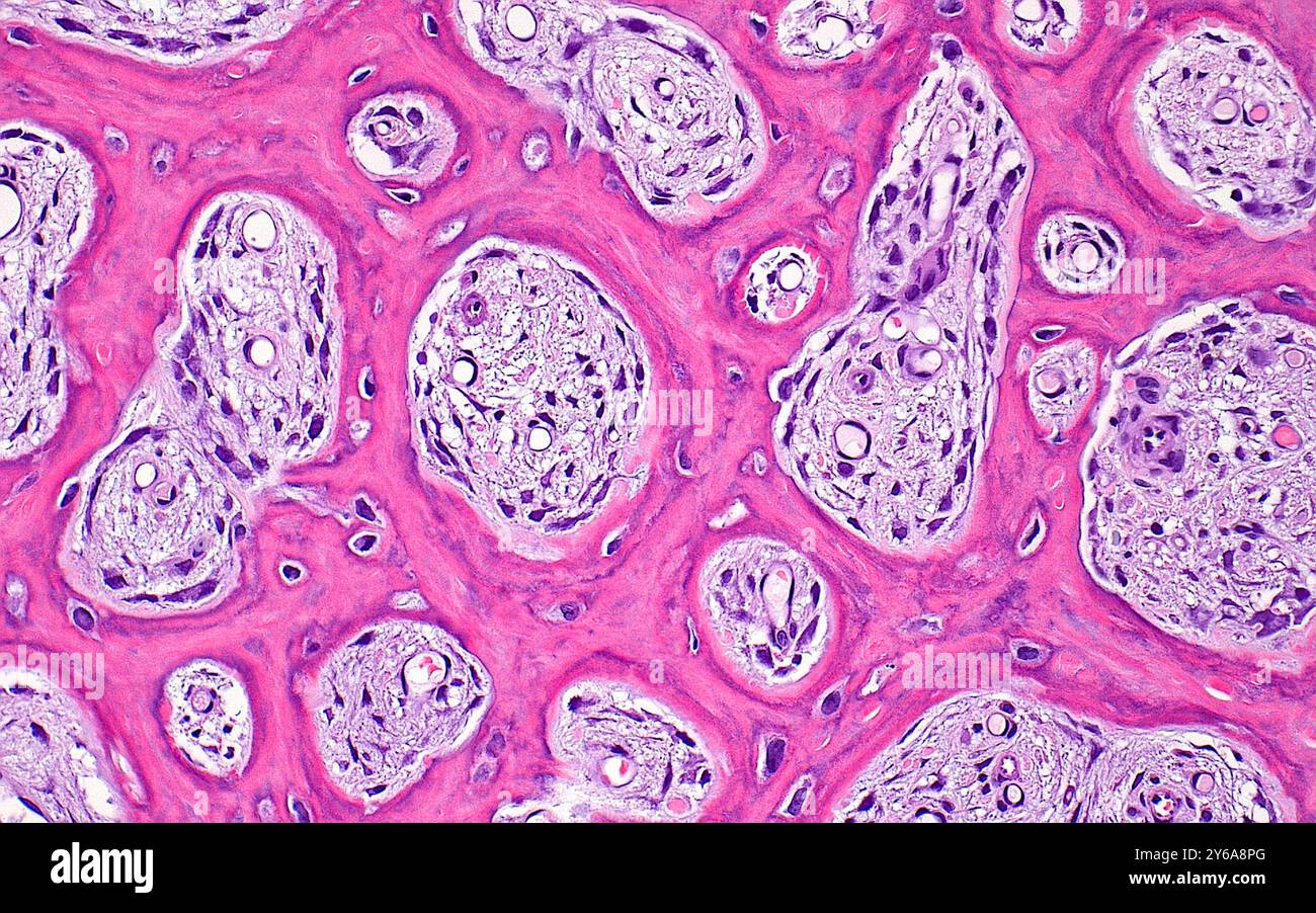 Light micrograph of woven bone. Woven bone is bone that is in early ...