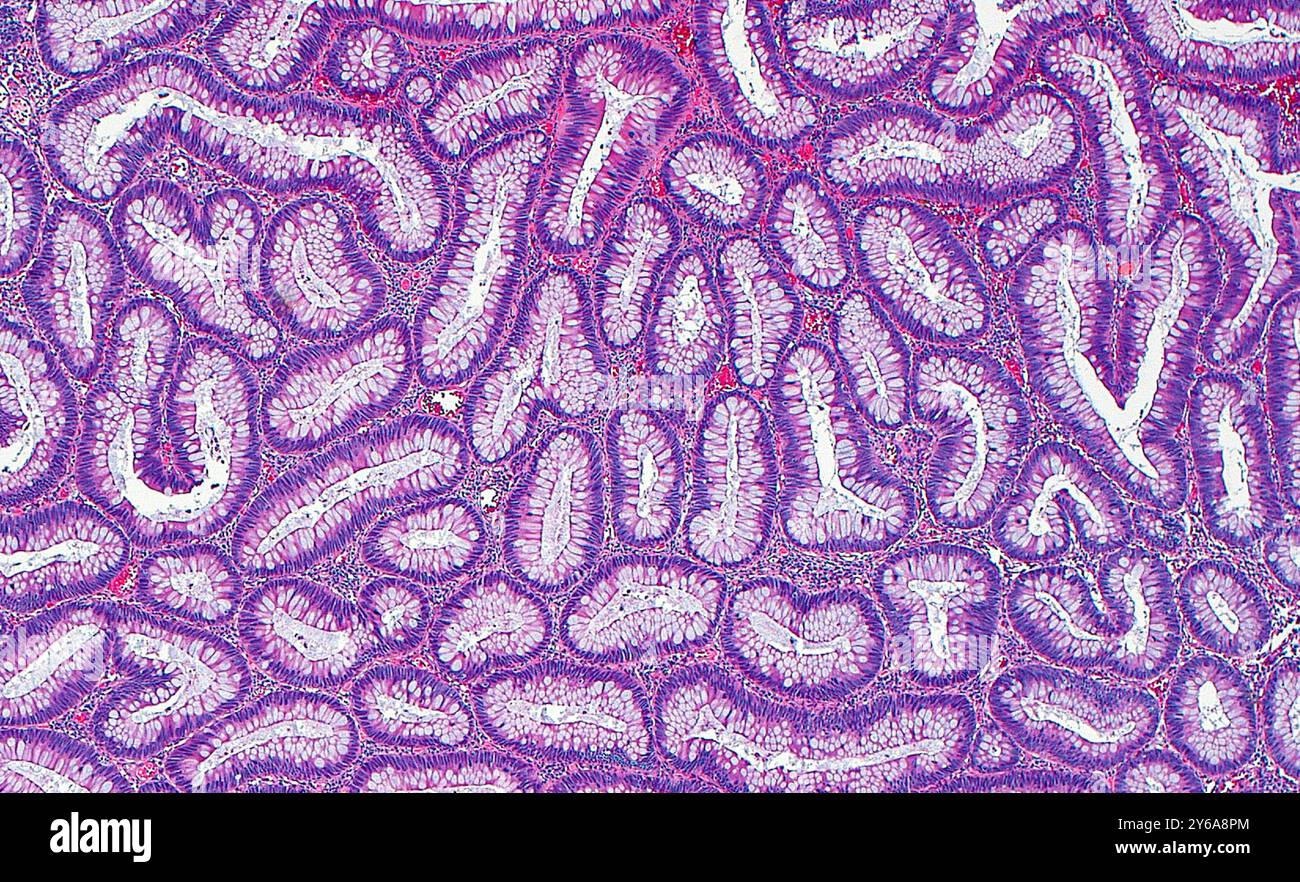 Light micrograph of a colonic tubular adenoma. The colon crypts ...