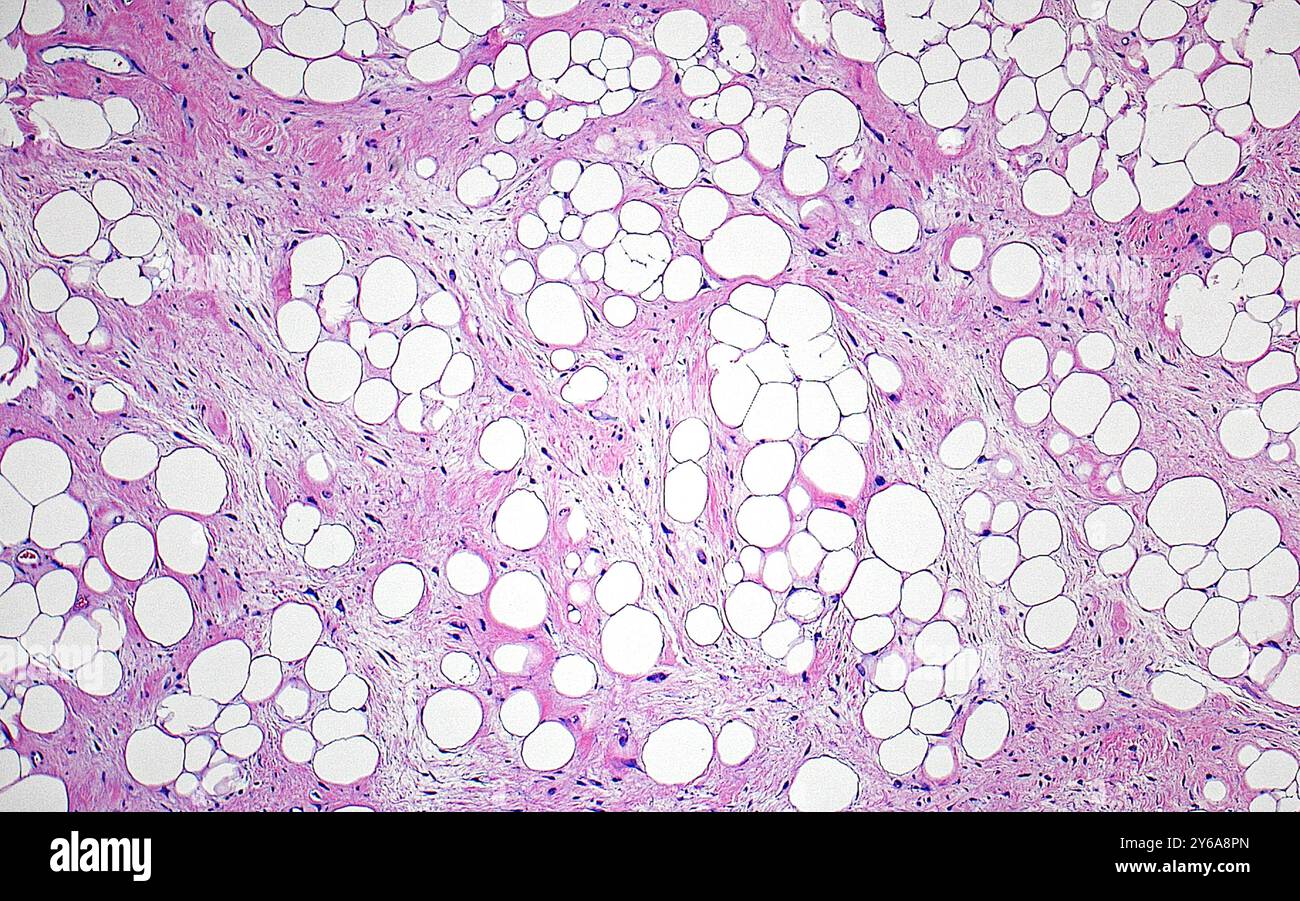Light micrograph of a well differentiated liposarcoma, a type of soft ...