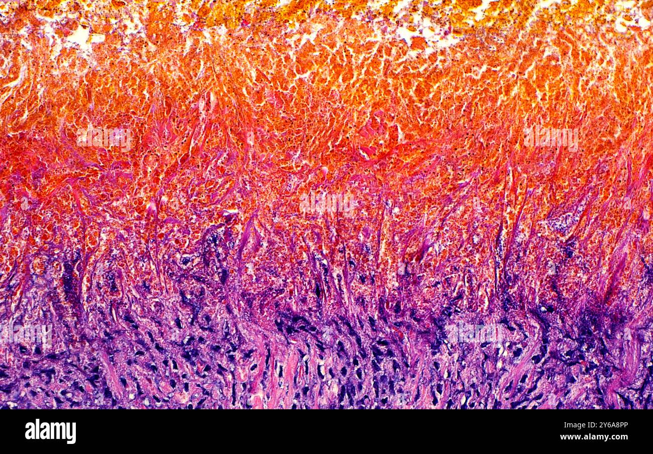 Light micrograph of necrosis in a treated hepatocellular carcinoma ...