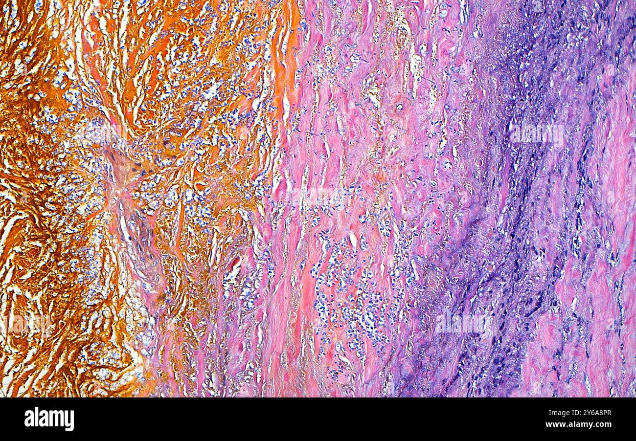 Light micrograph of necrosis in a treated hepatocellular carcinoma ...