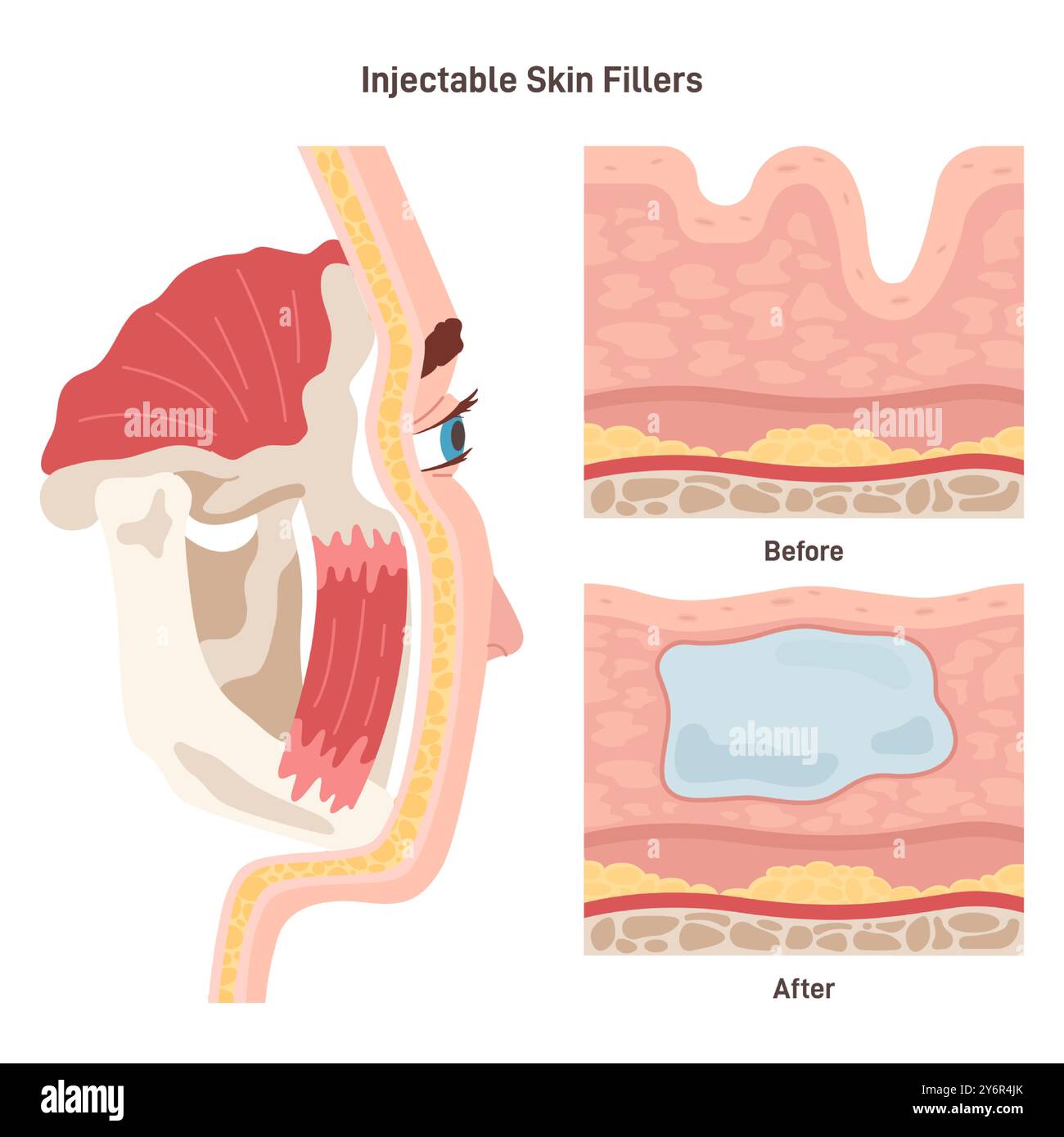 Injectable cosmetic filler. Face features correction or anti-aging ...