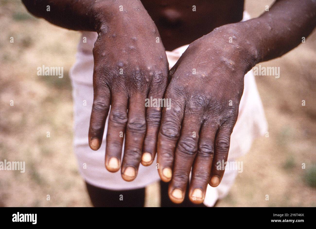 Monkeypox Outbreak, 1997 Stock Photo - Alamy
