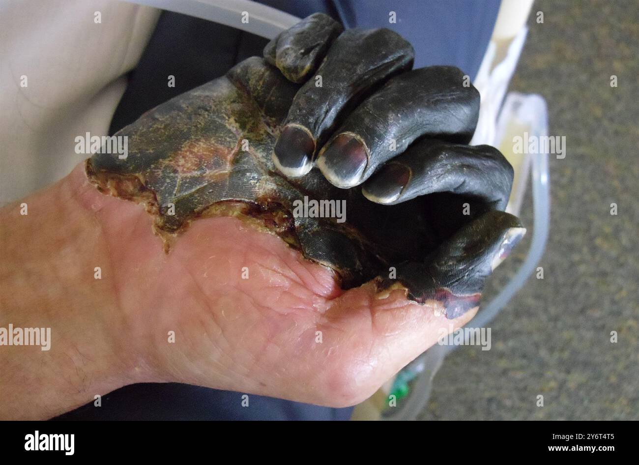 Gangrene, Bubonic Plague Stock Photo - Alamy