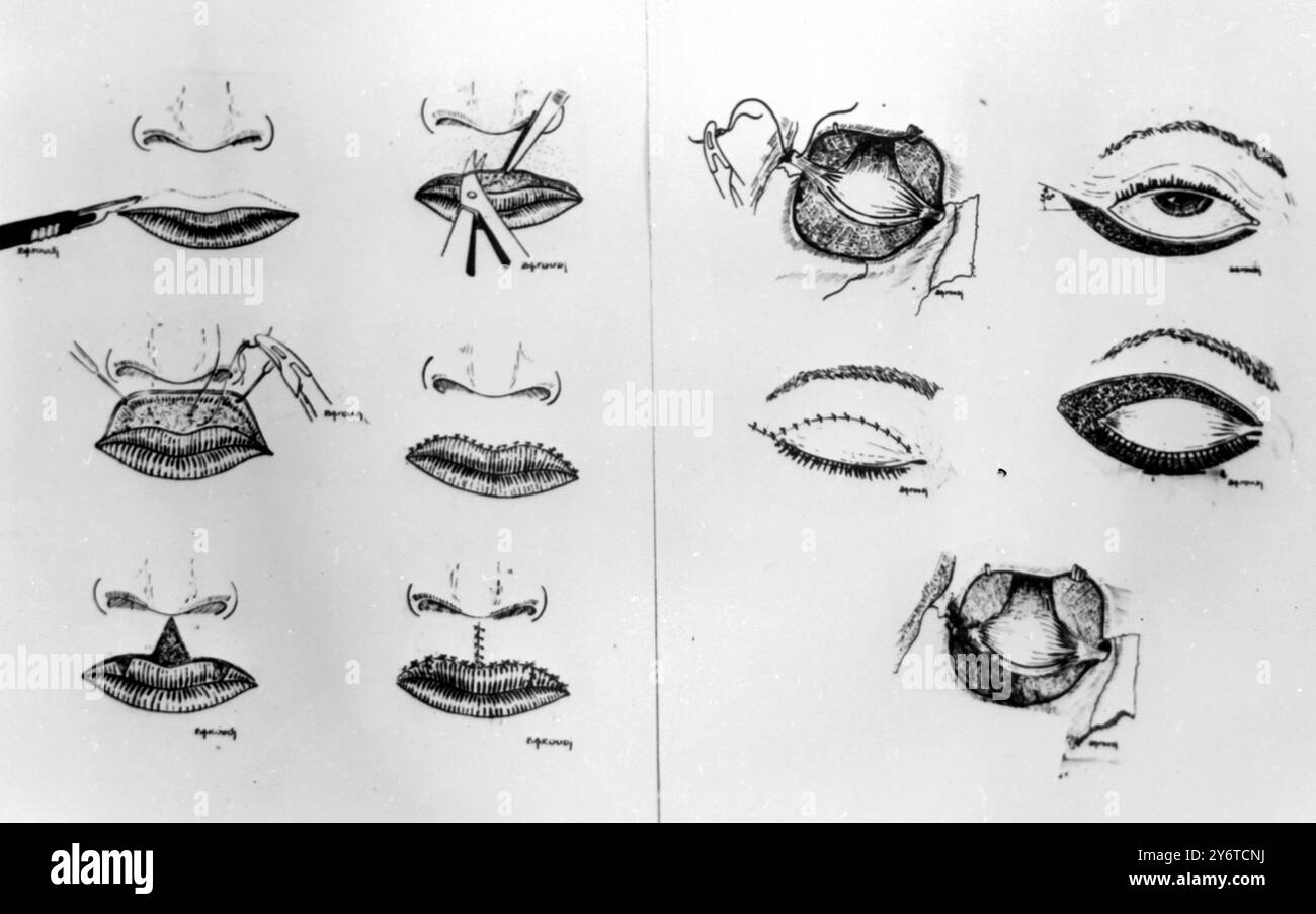 PLASTIC SURGERY CHART BEFORE AFTER PLASTIC SURGERY 26 NOVEMBER 1961 ...