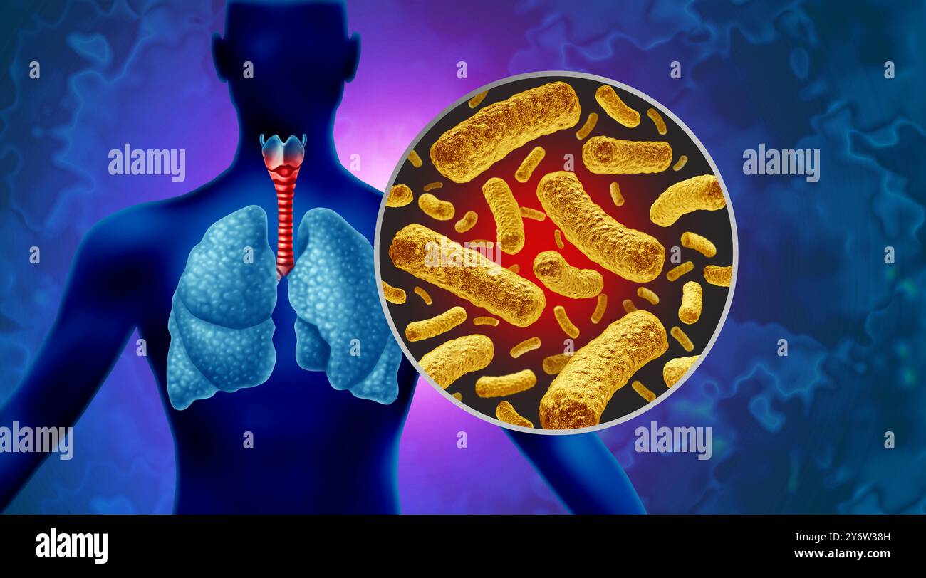 Whooping cough as a contagious respiratory disease with the bacterium ...