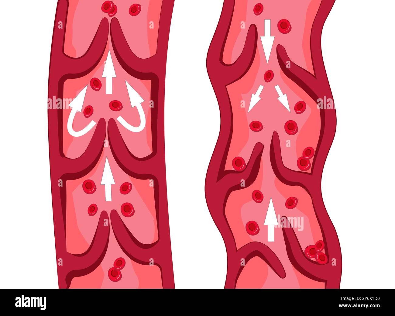 Illustrations of affected and healthy vein on white background ...