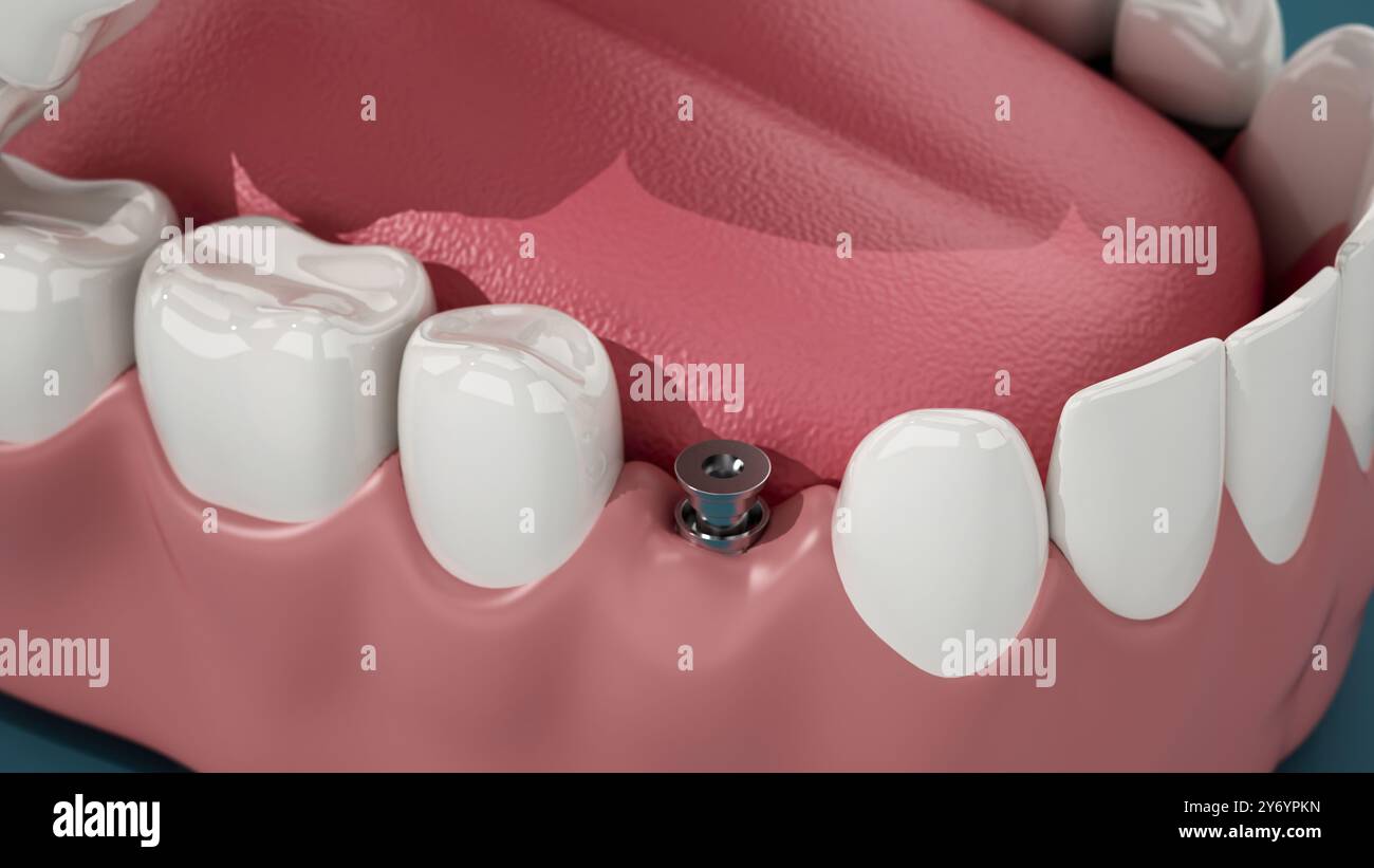 Detailed 3D illustration of a tooth implant procedure with realistic ...