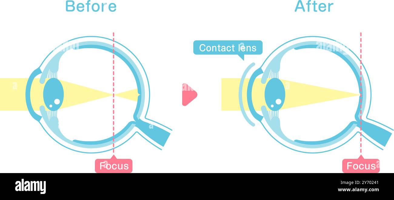 Illustration comparing vision before and after wearing contact lens ...