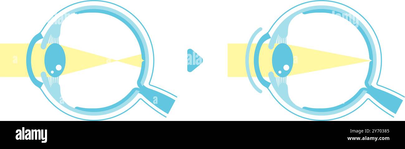 Illustration comparing vision before and after wearing contact lens ...