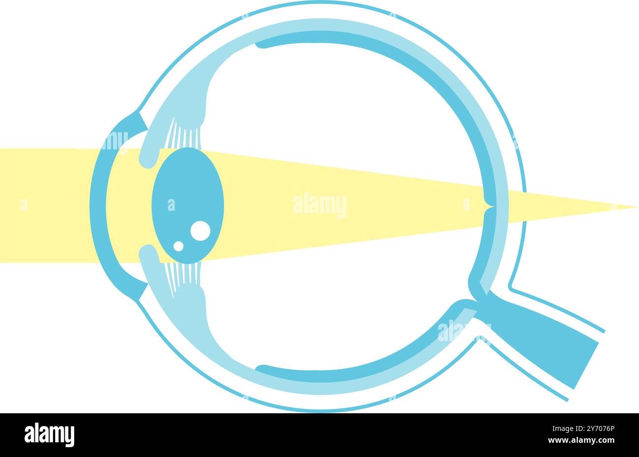 Vector illustration of hyperopia (no text Stock Vector Image & Art - Alamy