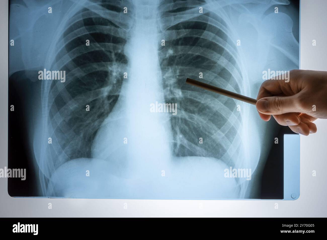 X-ray of the lungs. Doctor's view of the lung image in the hospital on ...
