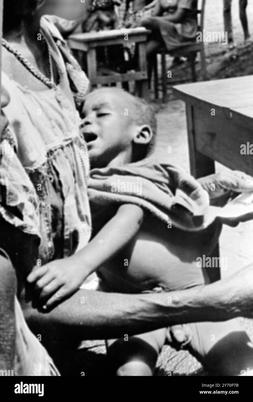 A baby , his stomach swollen from malnutrition , being nursed by his ...