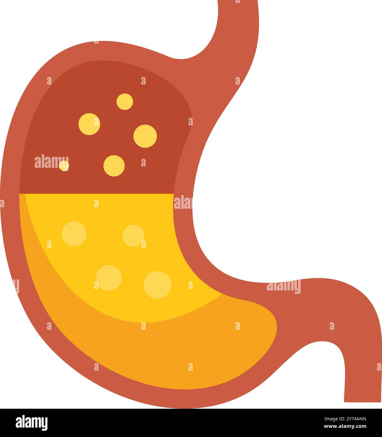 Illustration of a human stomach showing gastritis with acid coming up ...