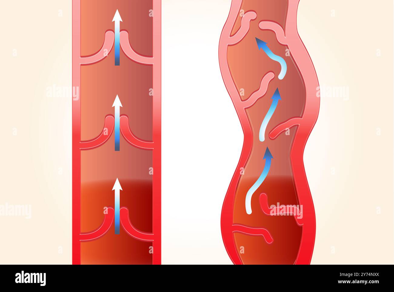 Illustrations of affected and healthy vein on white background ...
