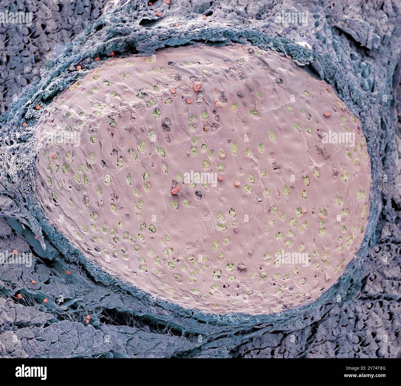 Rib fracture hi-res stock photography and images - Alamy