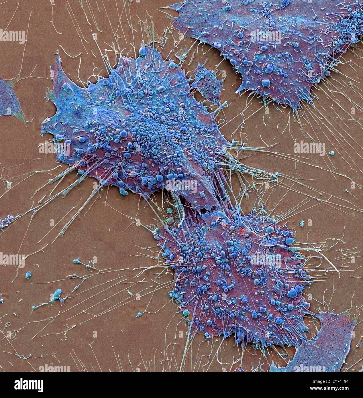 Bone cancer cells. Coloured scanning electron micrograph of ...