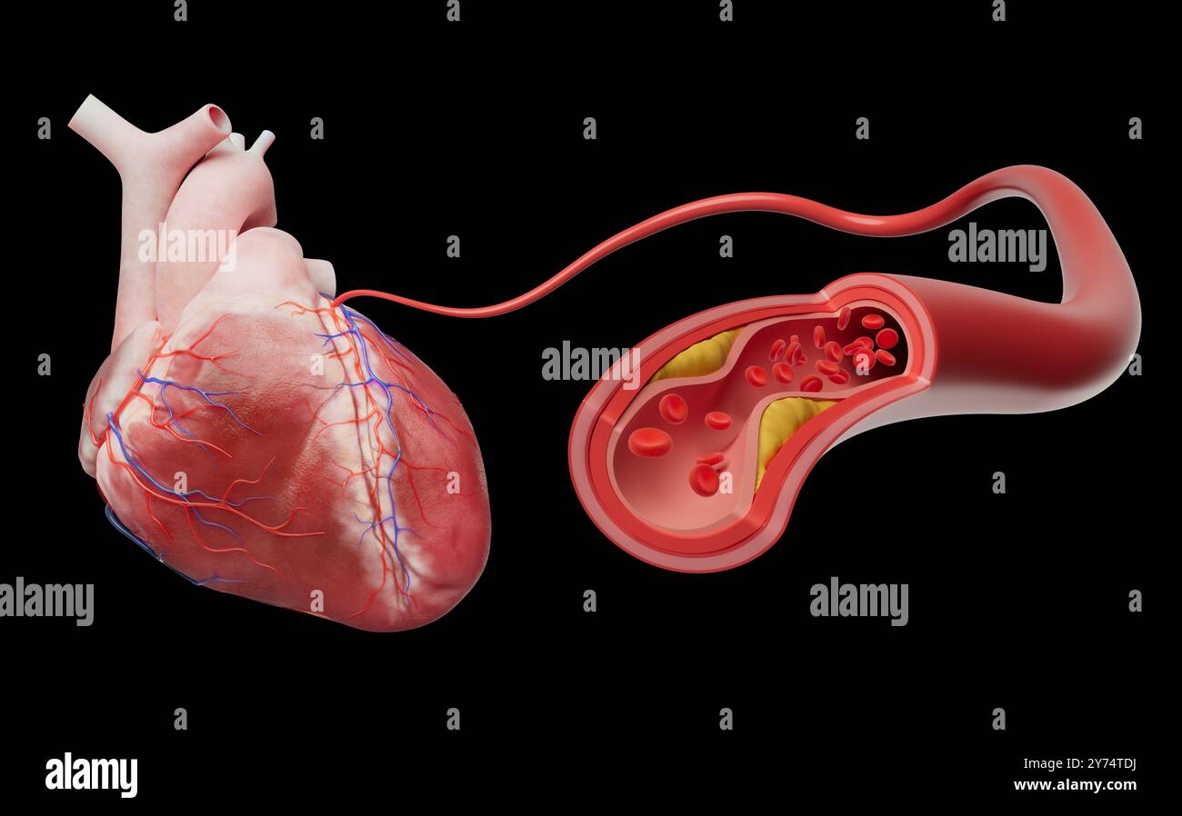 Illustration of coronary artery disease. It shows the narrowing or ...