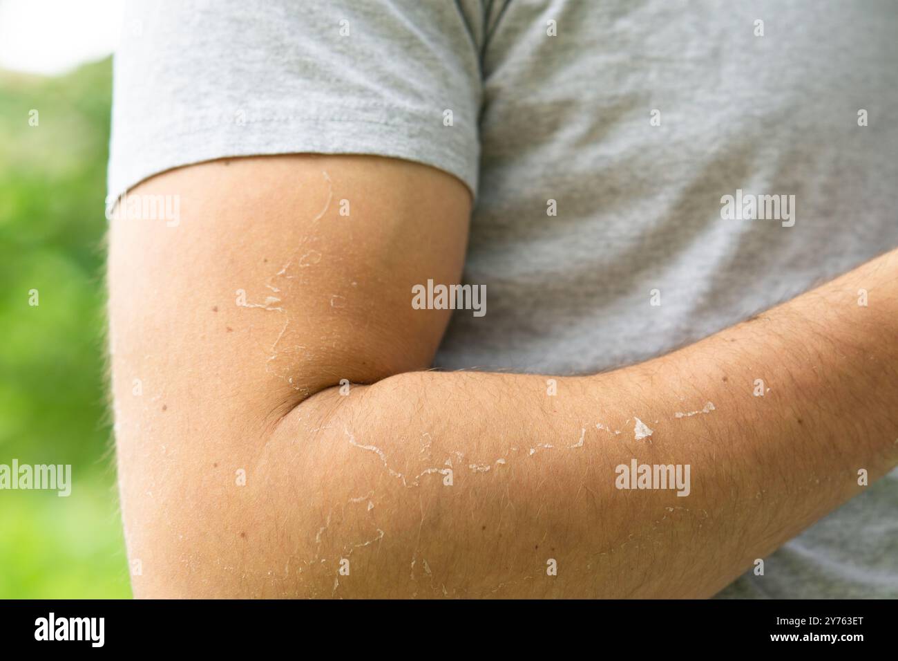 dry sunburn peeling skin on a man's arm Stock Photo - Alamy