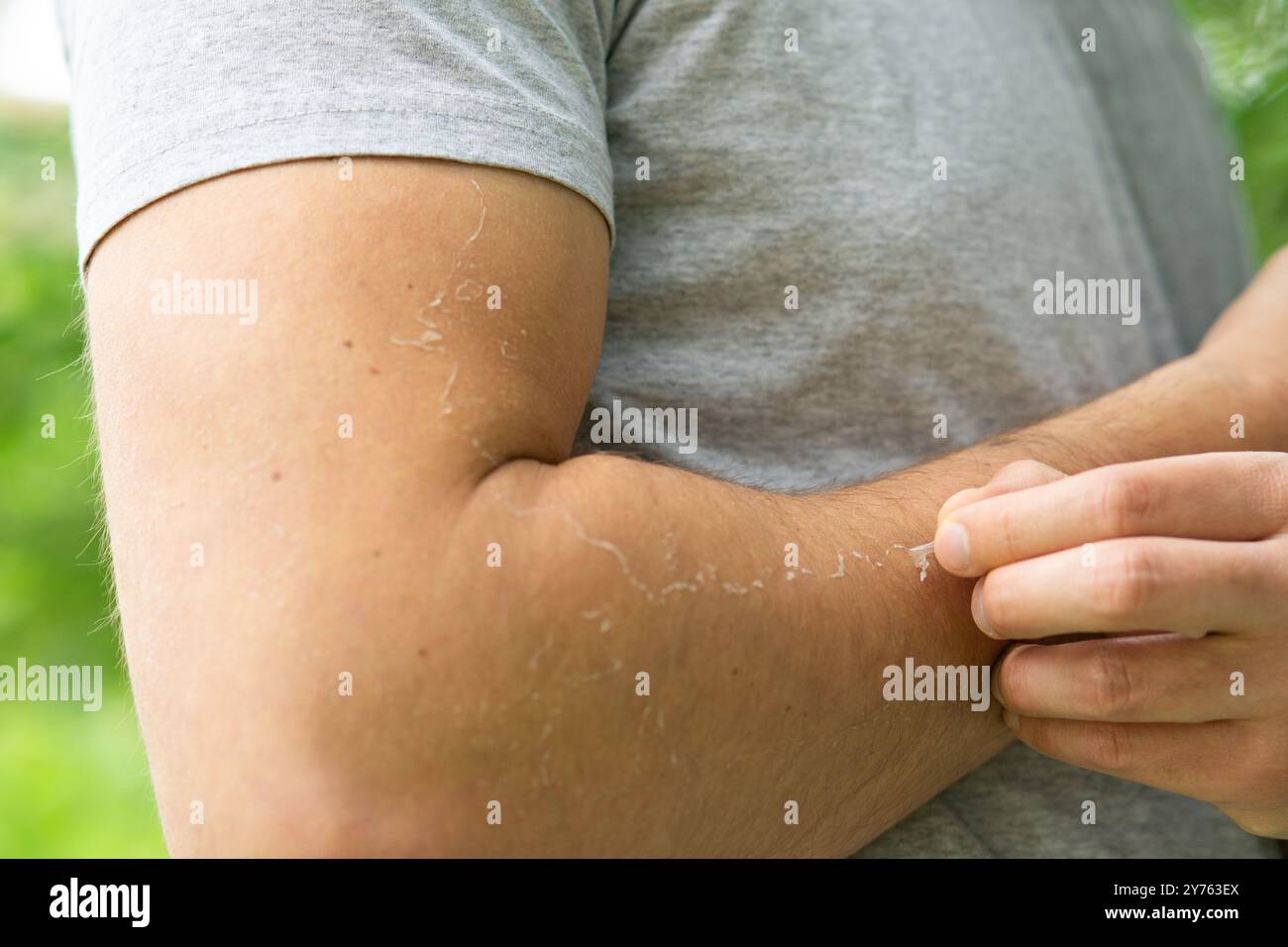 dry sunburn peeling skin on a man's arm Stock Photo - Alamy