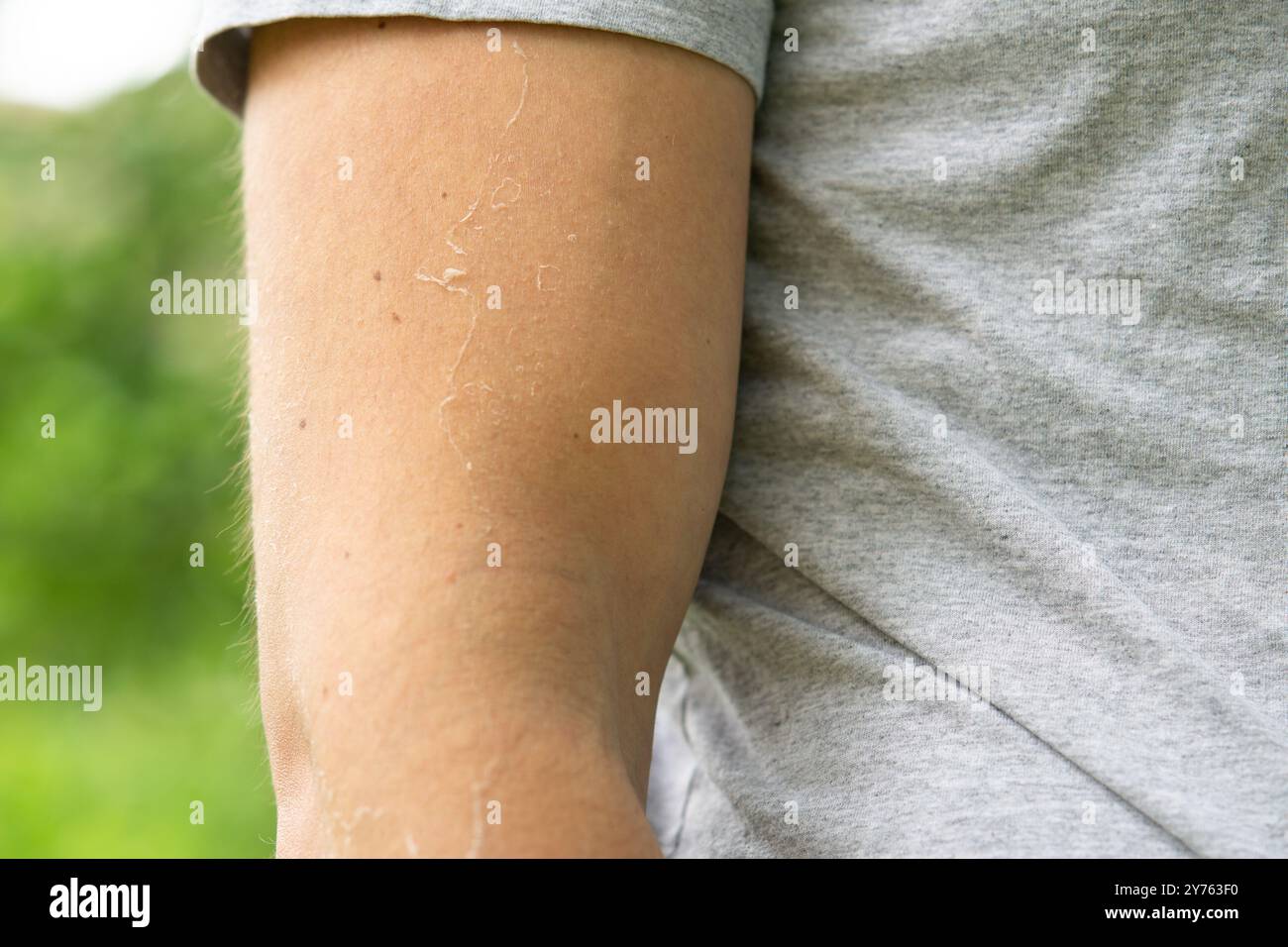 dry sunburn peeling skin on a man's arm Stock Photo - Alamy