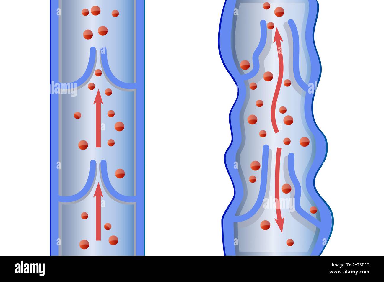 Illustrations of affected and healthy vein on white background ...