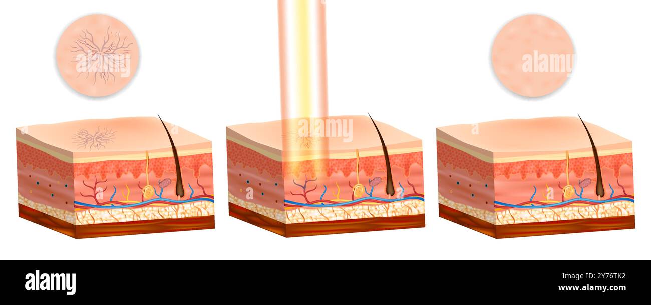 Laser Treatment for Telangiectasias and reticular veins Stock Vector ...