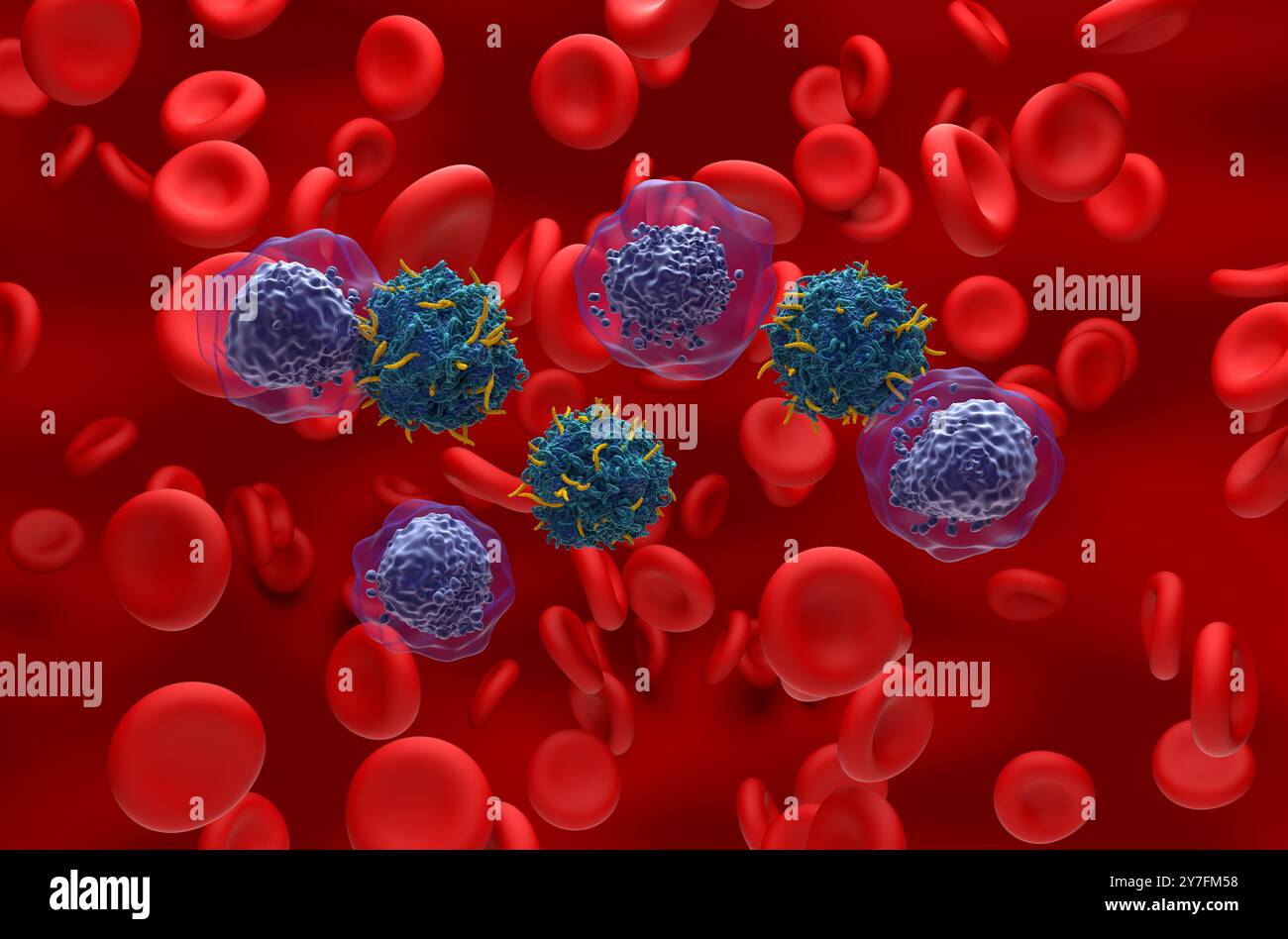 Acute Myeloid Leukaemia – Aml Disease – DUZNS