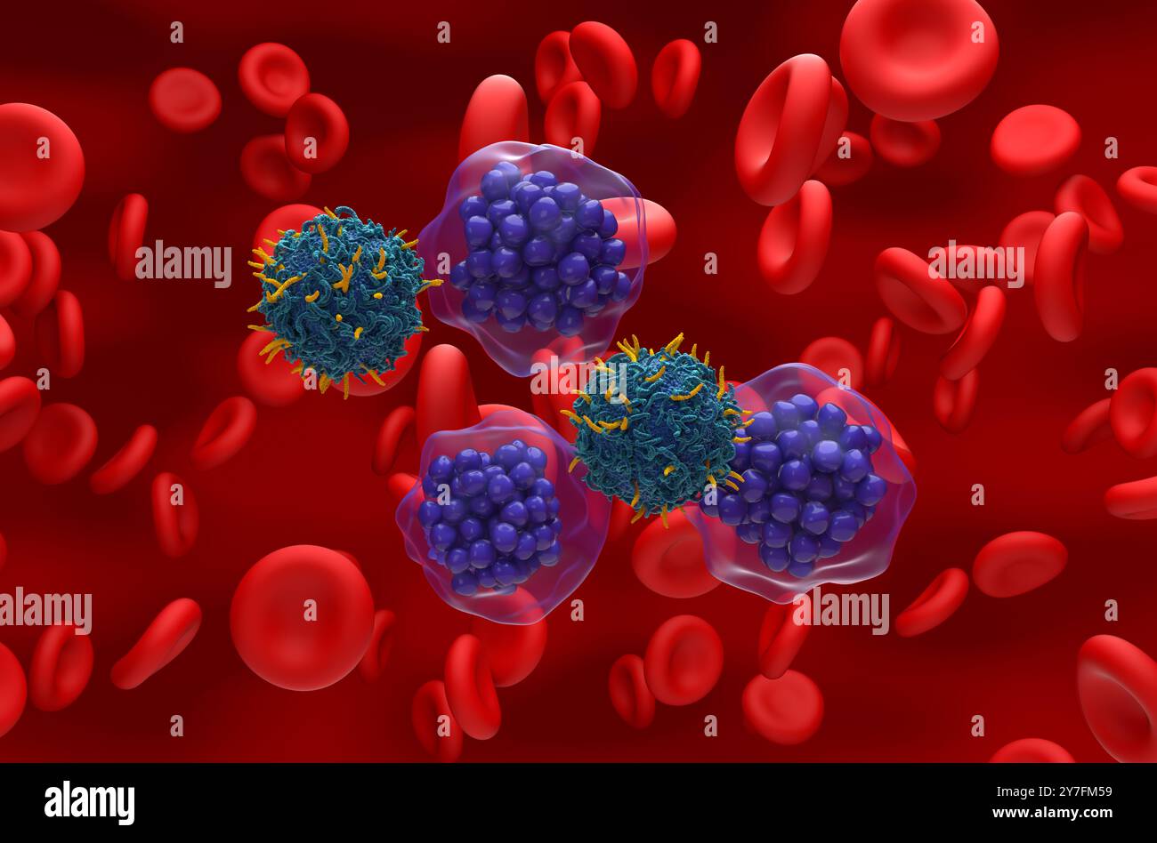 CAR T cell therapy in Diffuse large B-cell lymphoma (DLBCL) - isometric ...