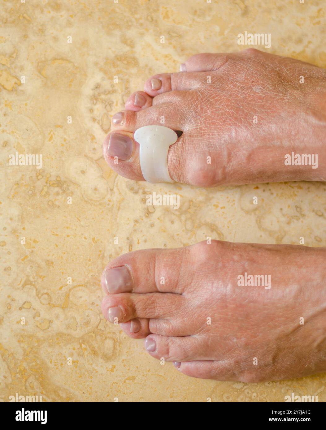 Treatment and prevention of hallux valgus. Silicone finger separator ...