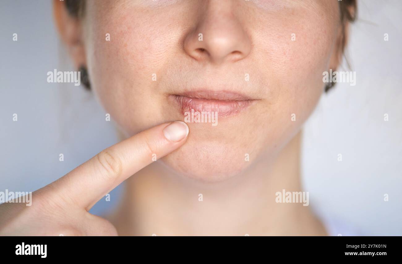 Skin care and lip health awareness with close up focus on cold sore and ...
