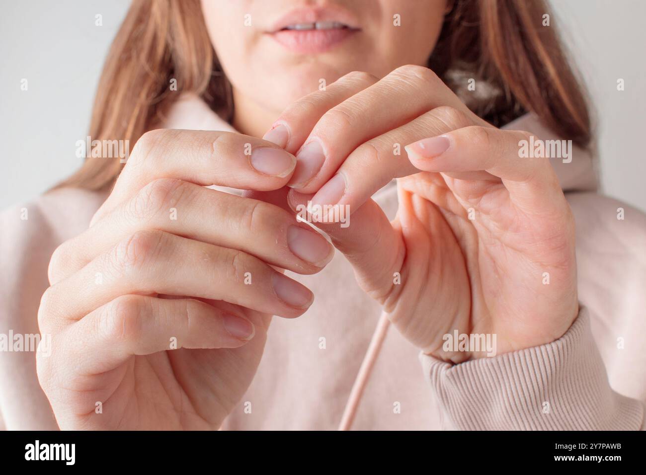 Onychophagy. A nervous young woman is biting her nail due to stress and ...