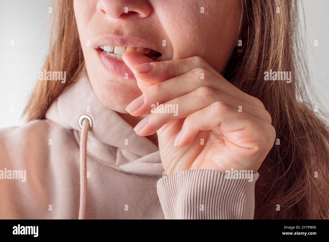 Onychophagy. A nervous young woman is biting her nail due to stress and ...