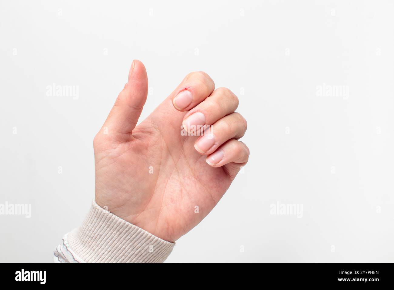 Closeup of deformed nails and torn, ripped and picked on cuticle skin ...