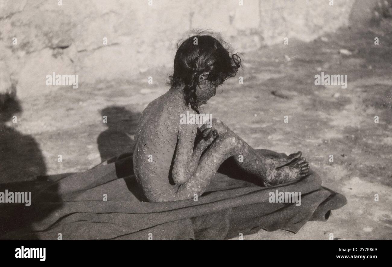 Smallpox palestinian girl hi-res stock photography and images - Alamy
